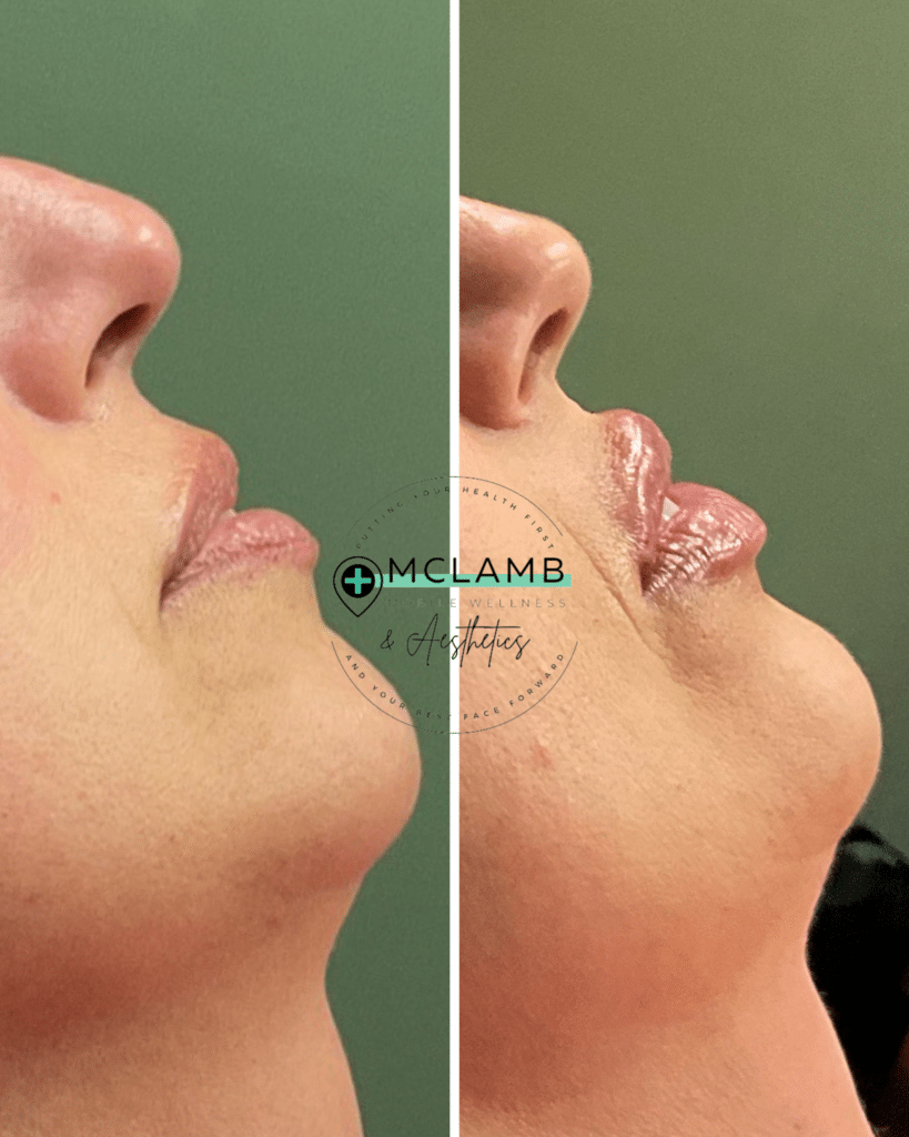 Aesthetics/“botox” — Elevated Aesthetics